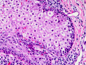 Derm Pathology: Sebaceous Adenoma